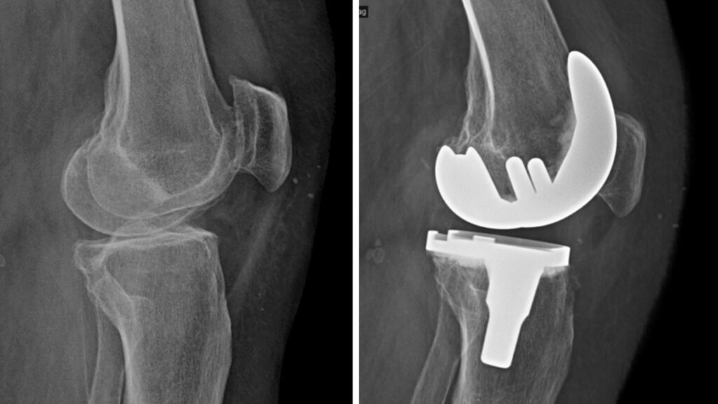 Knee Replacement Do Dr Tuna Pehlivano lu Knee Replacement Do Dr Tuna Pehlivano lu