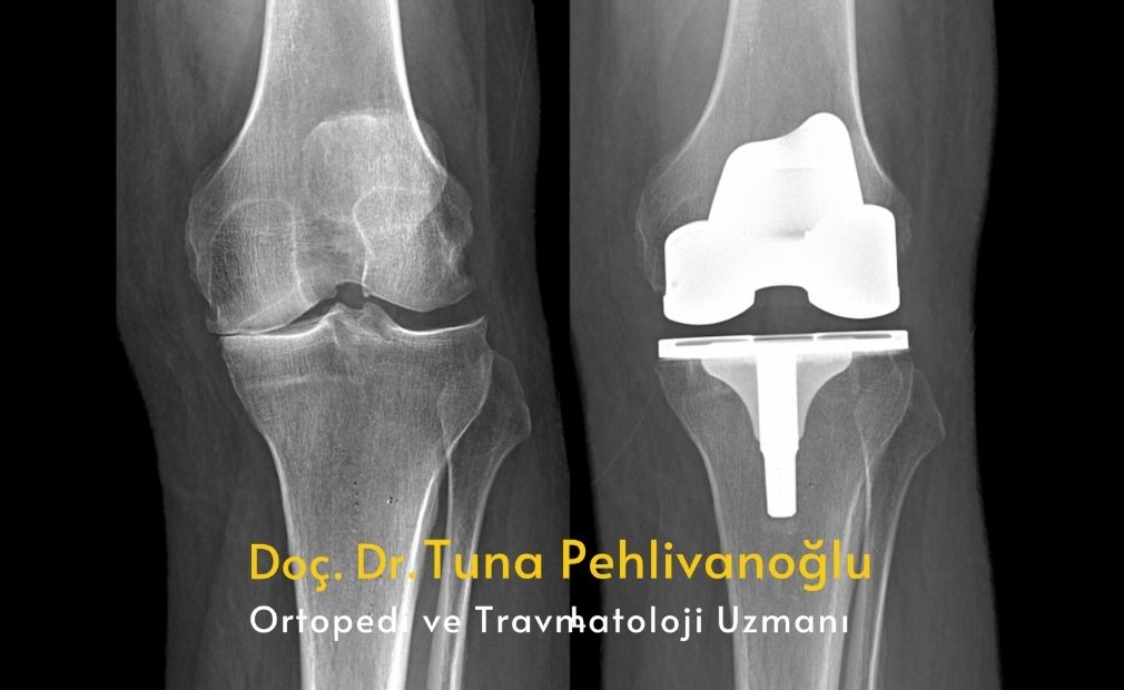 Knee Replacement Do Dr Tuna Pehlivano lu Knee Replacement Do Dr Tuna Pehlivano lu